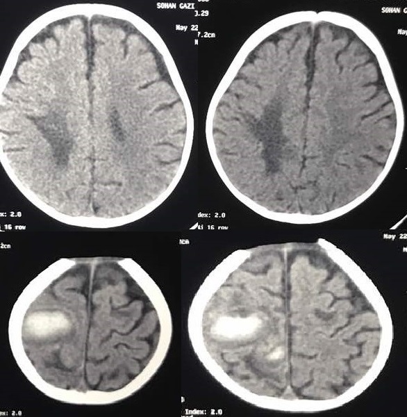 Perforated Mesenteric Cyst with Sepsis and Neurological Complication in ...