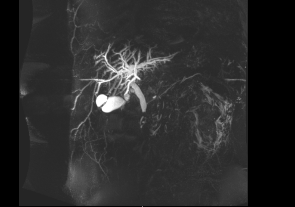 A Novel Approach for Removal of an Impacted Extraction Balloon Catheter ...