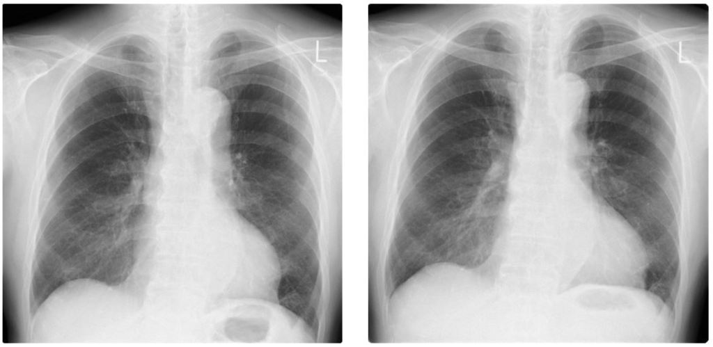 Clinical Significance of Chest CT Scan for Previous Heavy Smoker
