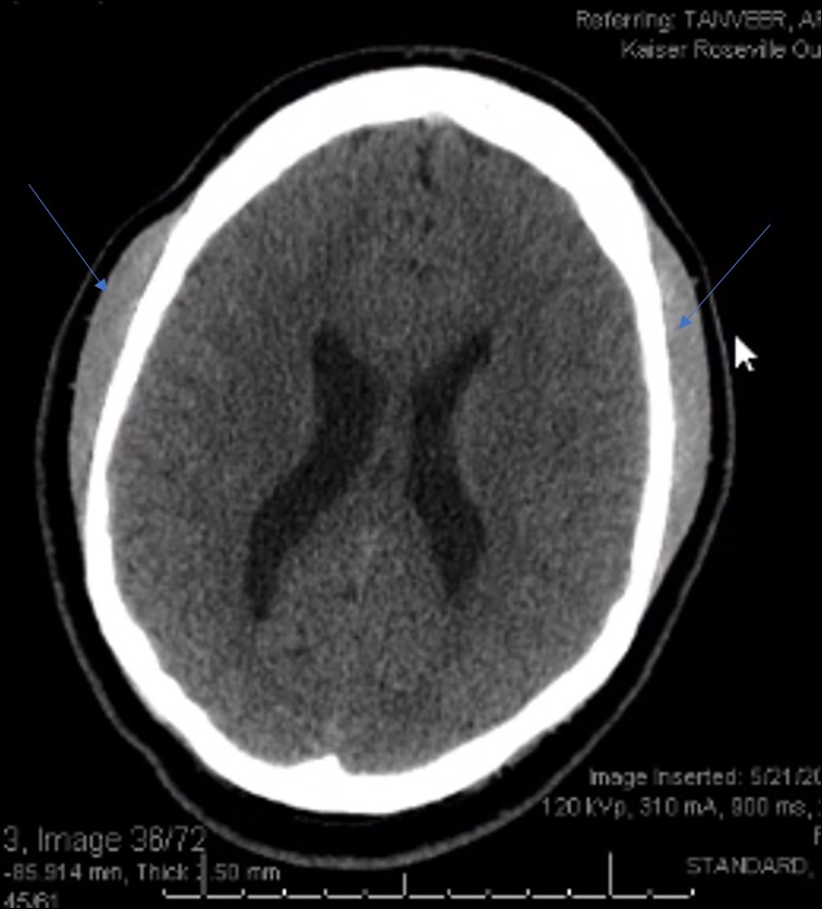 My Head is Getting Bigger: Macrocephaly with Cause Shown on CT Head ...
