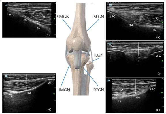 Application of Genicular Nerves Block Combined with iPACK Block in ...