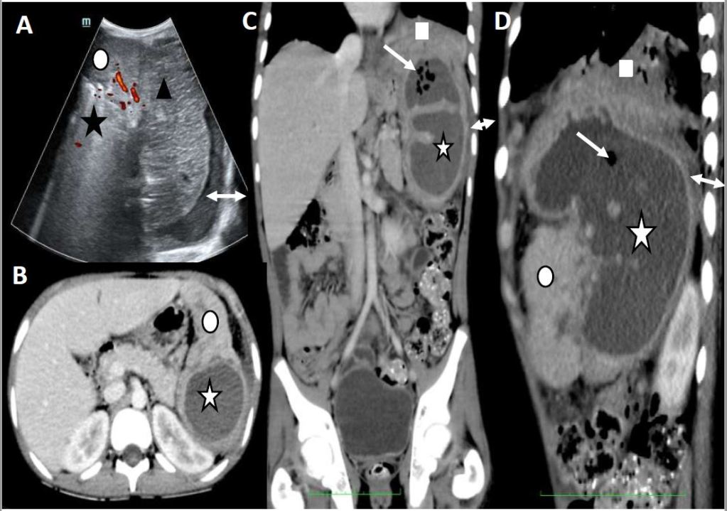 Massive Splenic Infarction Abscess in A Teenager with Sickle Cell ...