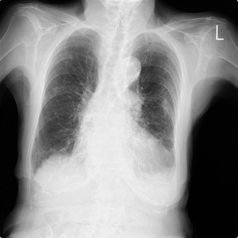 Slight Bronchopneumonia in A Centenarian Diagnosed by Chest CT Scan ...