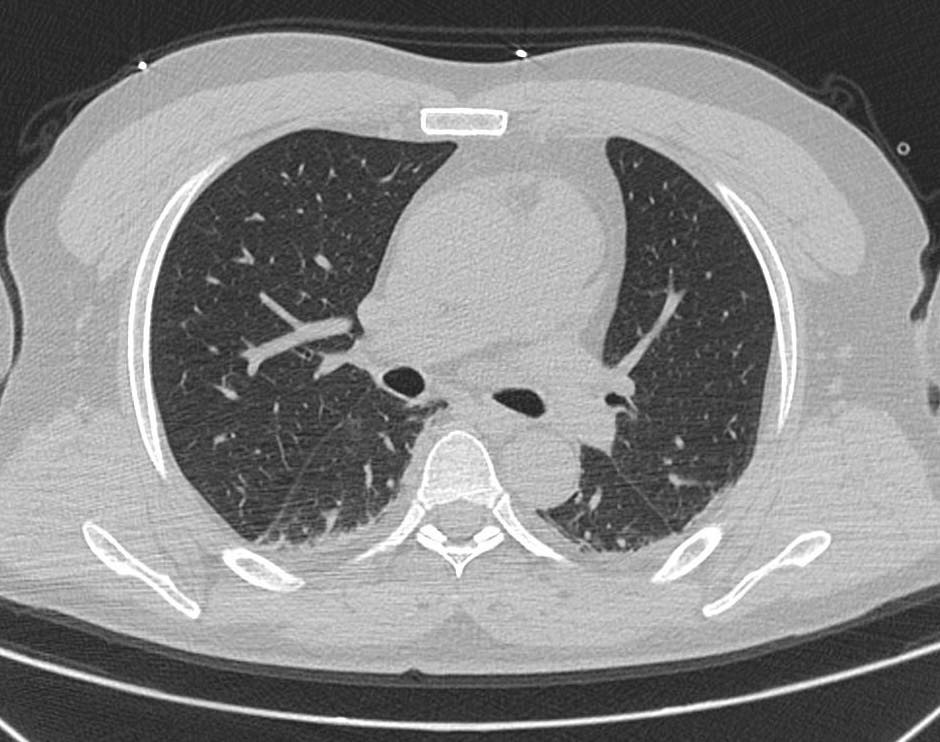 Anesthesia Management of Severe Hypoxemia During Total Arch Replacement ...