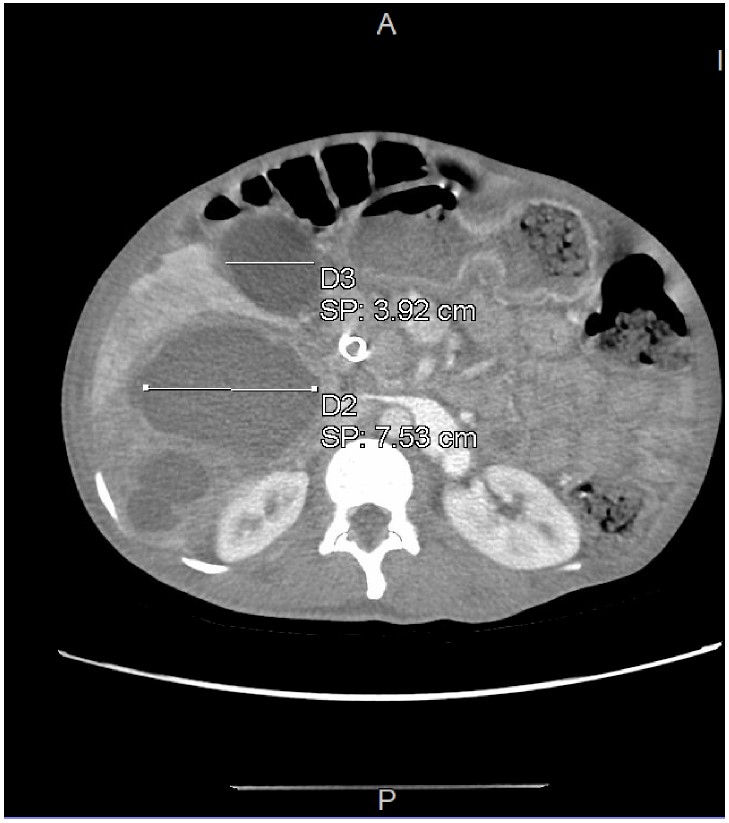 Liver Abscess Management in a Complex Oncologic Case