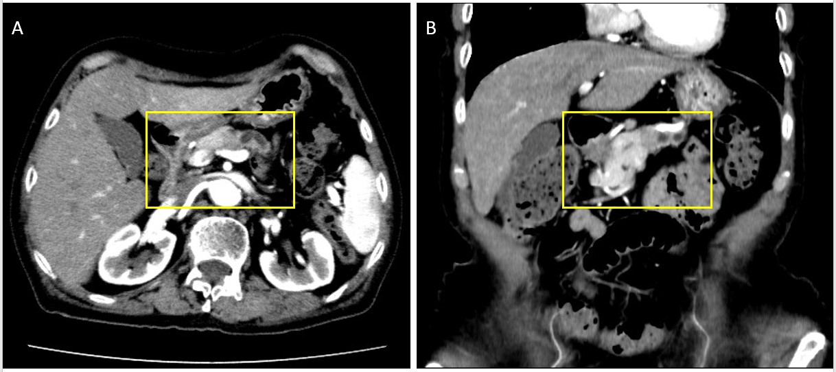 Detection of Pancreatic Tumor by The Radiological Measure of Curved ...