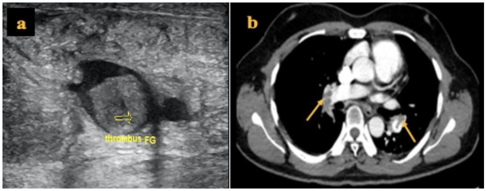 Marantic Endocarditis Associated with Metastatic ...