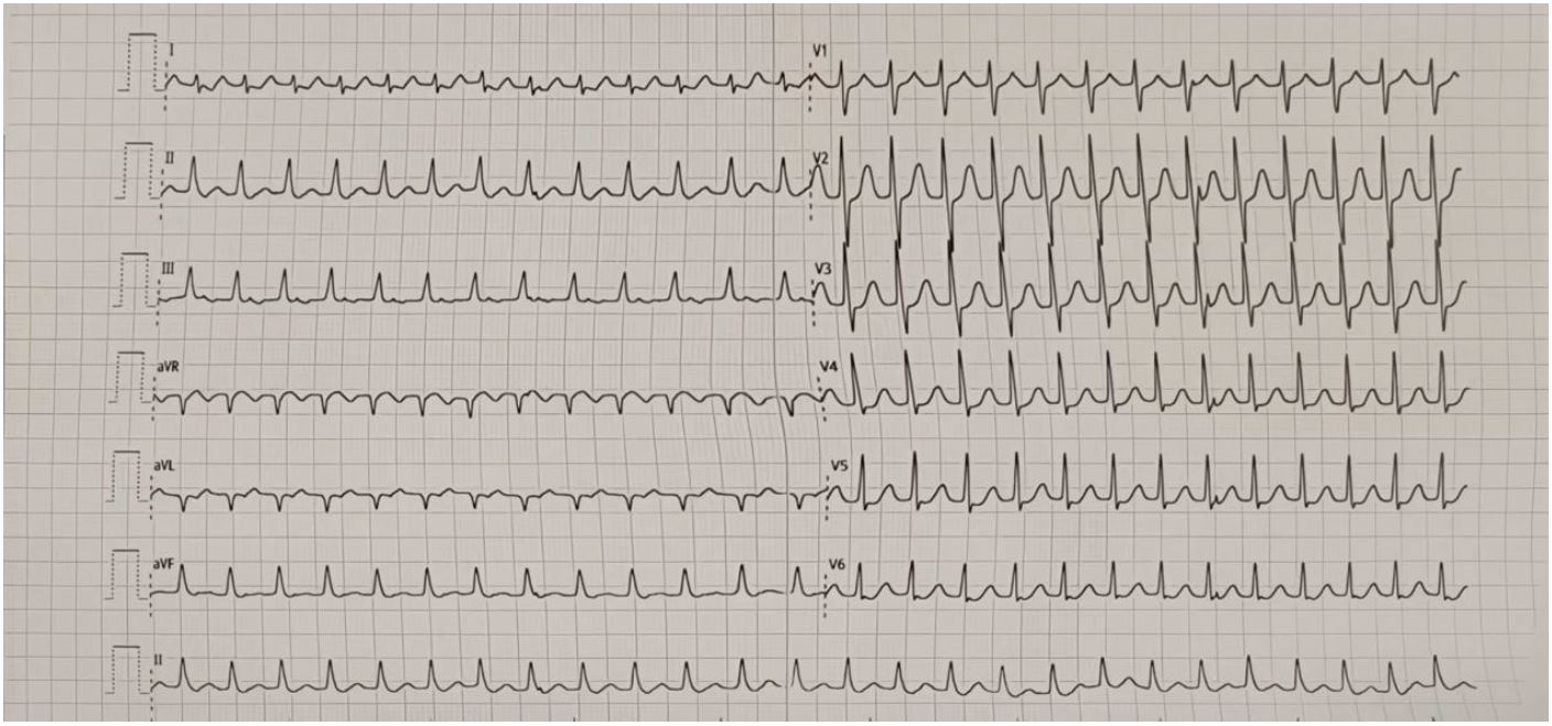 Acute Severe Chest Pain with ST-Segment Elevation in Inferior Leads ...